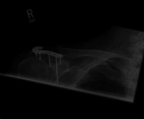 bone fracture detection object detection dataset v4 v4 by veda