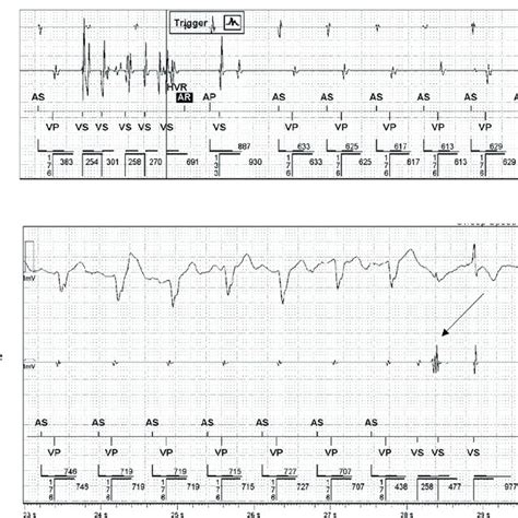 The Flowtriever System Inari Medical Irvine Ca A The Triever 20