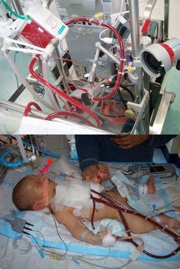 Brompton Awareness Royal Brompton Hospital Is One Of The Specialist