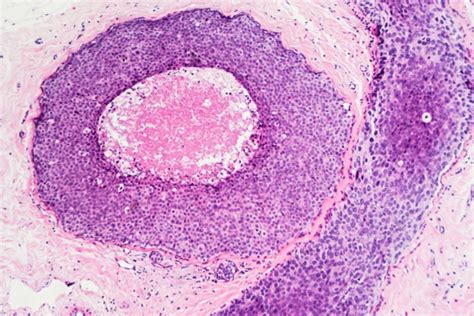 Ductal Carcinoma In Situ Course Radcomm