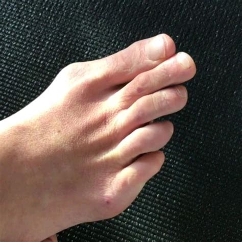 Toe Abduction And Adduction By Bernadette C Exercise How To Skimble