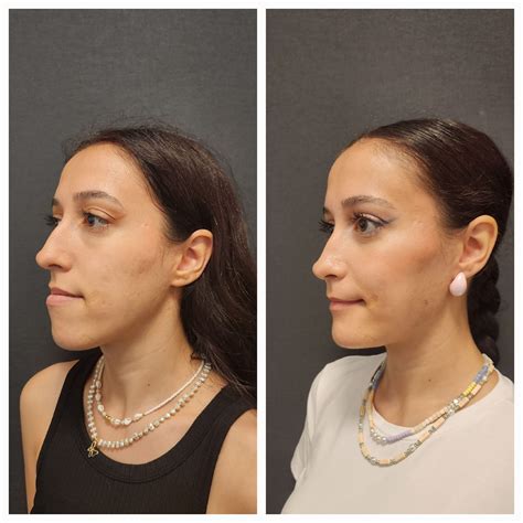 Jaw Surgery Turkey Comprehensive Overview And Cost Prof Dr Celal