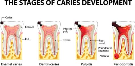 Emergency Dentist Los Angeles What To Do About Your Tooth Ache