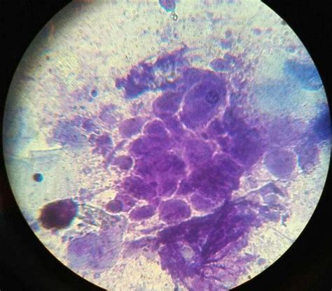 Multinucleated Giant Cells Download Scientific Diagram