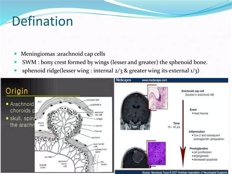 Sphenoid Wing Meningioma Pptx