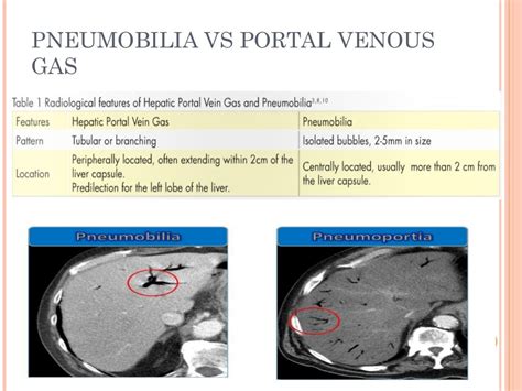Pneumobilia Vs Portal Vein Gas