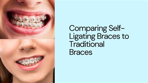 Comparing Self Ligating Braces To Traditional Braces