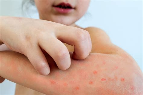 Chickenpox Transmission