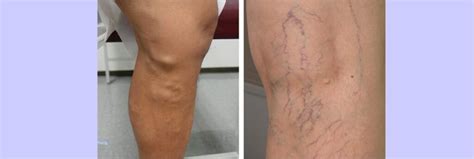 Varicose Veins Vs Spider Veins Understanding The Difference