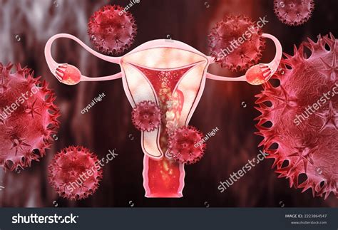 Uterus Uterine Cancer Medical Concept Cancerous Stock Illustration