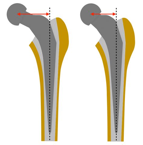 Femoral Component Offset Femoral Components With A High Offset
