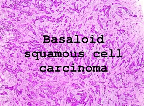 Pathology Mcq 📊 Basaloid Scc Vs Basal Cell Carcinoma Facebook