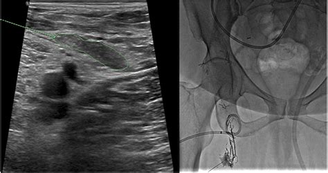 Intranodal Glue Embolization A Definitive Treatment For Groin