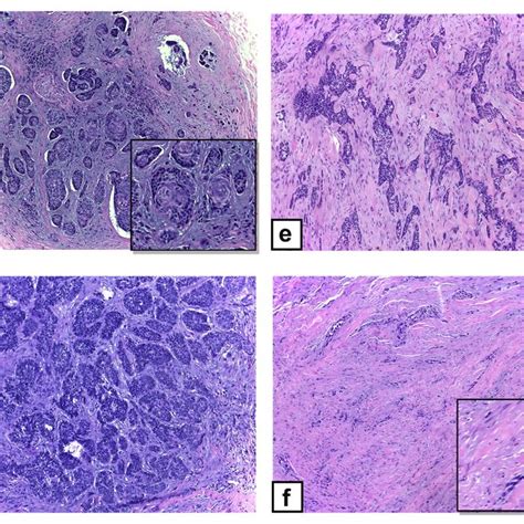 Histomorphological Characteristics Of Subtypes And Variants Of Bcc A Download Scientific