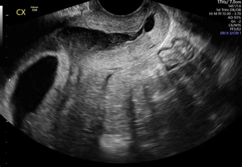 First Trimester Cervical Funneling Rare Case Study