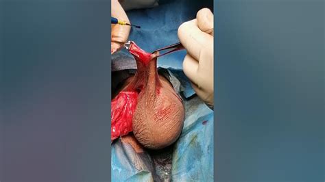 Bilateral Testicular Hydrocelectomy Drtalib H Al Shawoush Specialist Surgeon Youtube