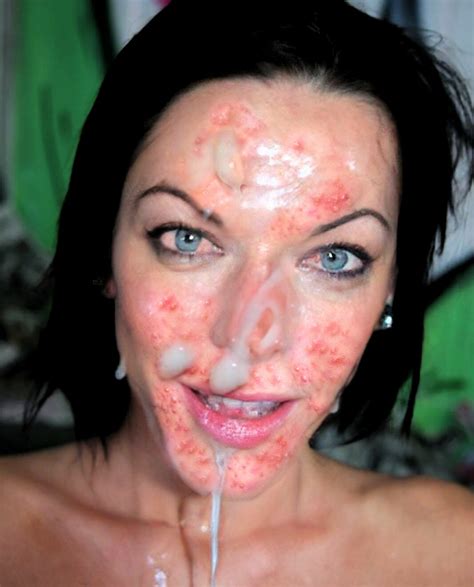 Acne Teen Sex Pictures Pass