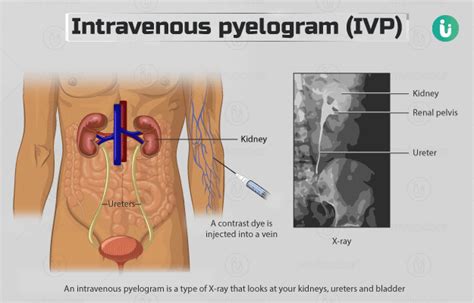 Intravenous Pyelogram Ivp Procedure Purpose Results Normal Range Cost Price Online Booking