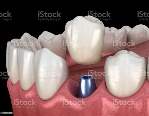 임 플 란 트를 사용한 사전 몰 치 회복 인간의 치아와 의치 개념의 의학적으로 정확한 3d 그림 건강관리와 의술에 대한 스톡 사진 및 기타 이미지 Istock