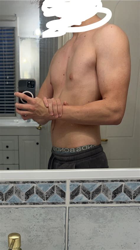 Severity Of Pe Rpectusexcavatum