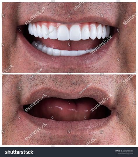 1 970 Occlusion Implant Images Stock Photos Vectors Shutterstock