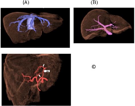 Ct With Hepatic Protocol And 3d Imaging Reconstruction Showing A