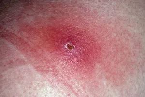 Carbuncles Causes Symptoms And Treatments