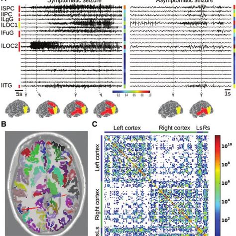 Stereotactic Eeg Data And Reconstruction Of Virtual Patient Cj A Two Download Scientific