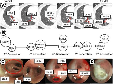 A And B Schematic Drawing Of Left Lower Basal Segment Corresponding Download Scientific