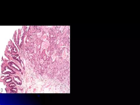 Interpretation Of Endoscopic Gastrointestinal Biopsy Ppt