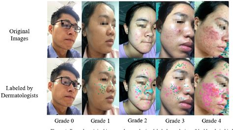 Table 1 From Automatic Acne Object Detection And Acne Severity Grading Using Smartphone Images