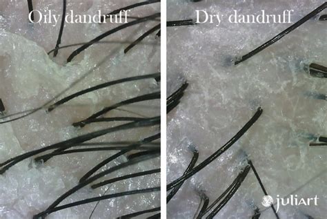 Dandruff Remedy How To Get Rid Of Dandruff And Itchy Scalp JuliArt