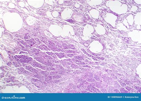 Histopathology Of Interstitial Pneumonia Stock Image Image Of Histology Histopathology 130896669