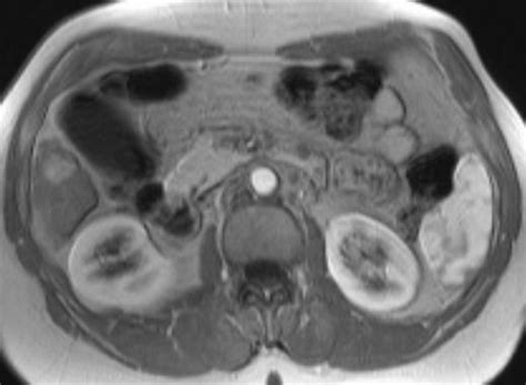Hepatic Dysplastic Nodule Mri Findings Eurorad
