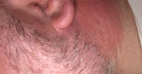 Cellulitis On Head Album On Imgur