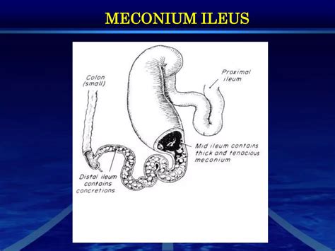 Neonatal Bilious Vomiting Part2 Pptx
