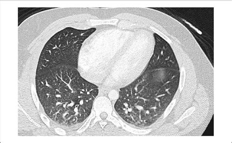 Computed Tomography Revealing Tree In Bud Opacities Predominantly In Download Scientific