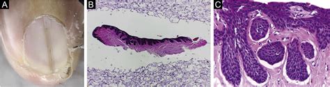A New Technique Of Paraffin Embedding Of Formalin Fixed Nail Sample