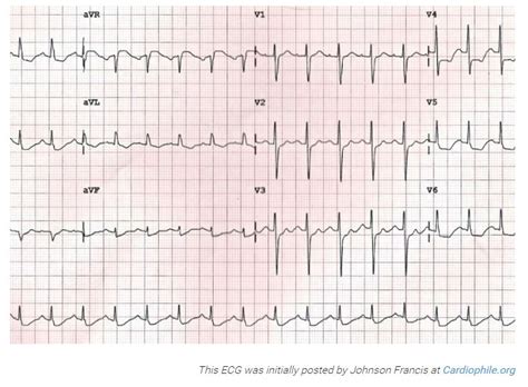 Lmca Occlusion The Em Goldfields