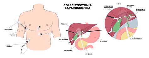 Anatomia Da Colecistectomia Laparoscopica