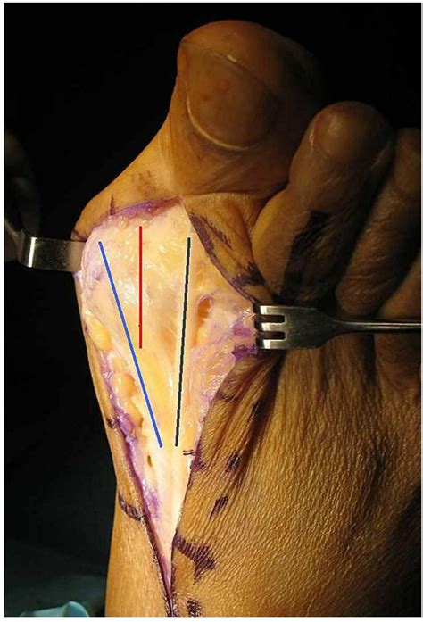 Figure 3 First Metatarsal Cuneiform Arthrodesis For The