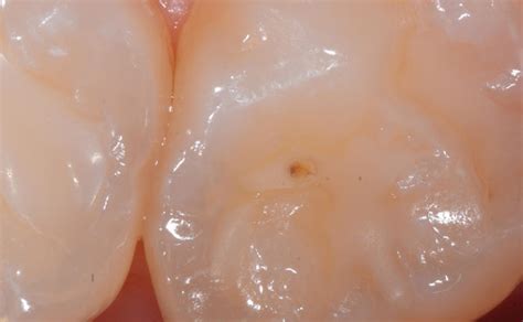 A Love Hate Relationship With Flowable Composites