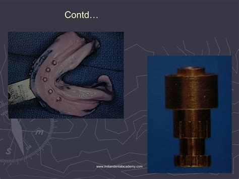 Classification And Impression Techniques Of Implants Dentistry Dental Implants Ppt