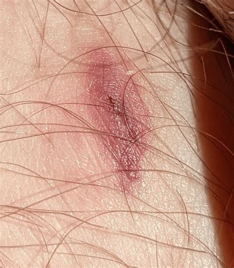 Bleeding Lesion In Groin Not Aware Of Mole No Cyst Or Pimple Flat To Touch Not Itchy Over