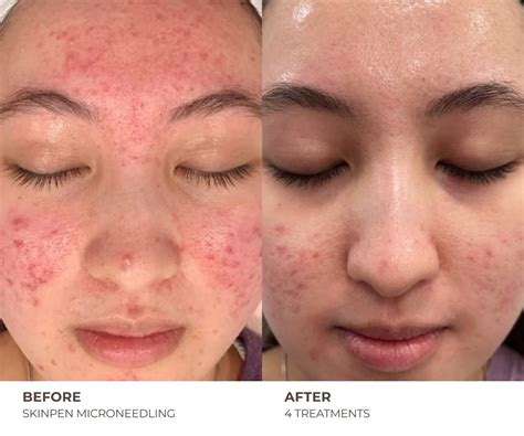 Skinpen Microneedling Smooth And Renew Your Skin Sev Laser