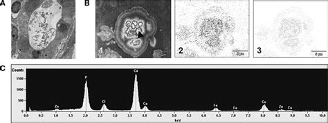 Role Of The Calcium Sensing Receptor In Reducing The Risk Fo