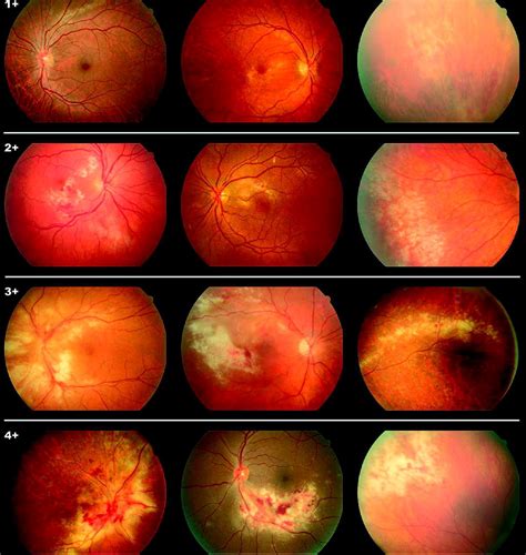 Characteristics Of Untreated Aids Related Cytomegalovirus Retinitis I