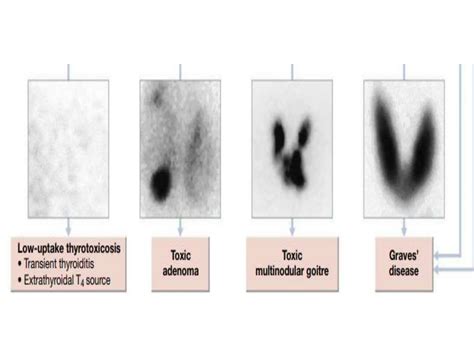 Hyperthyroidism Ppt Pptx