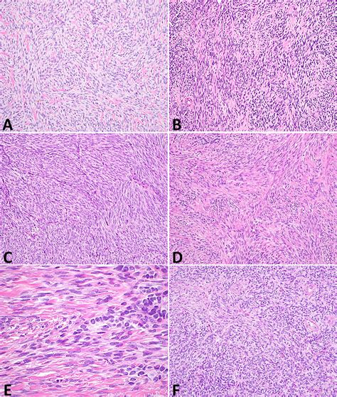 Clinicopathologic And Molecular Spectrum Of Testicular Sex Cord Stromal Tumors Not Amenable To