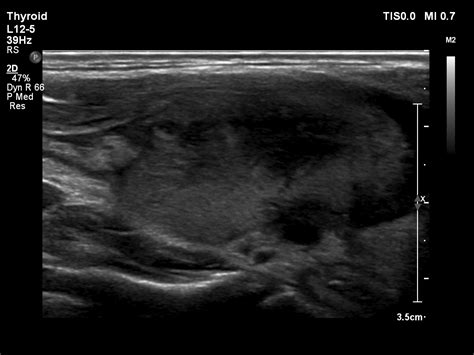 Subacute Thyroiditis